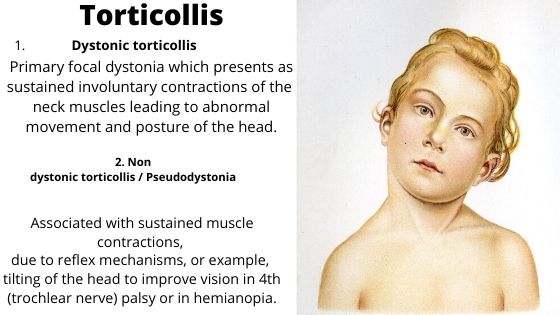 Comprehensive Guide to Torticollis: Symptoms, Causes, Treatment