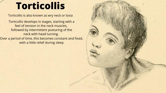 Comprehensive Guide to Torticollis: Symptoms, Causes, Treatment