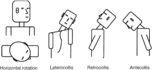 Comprehensive Guide to Torticollis: Symptoms, Causes, Treatment